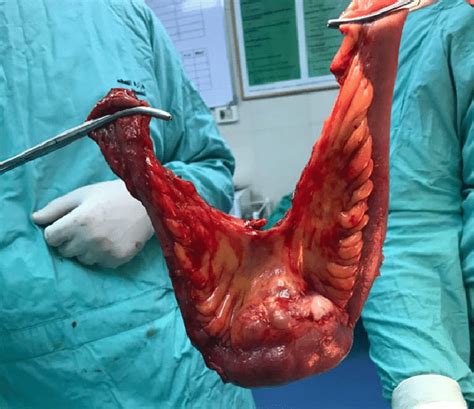 Gross Total Resection Of The Mass With 30 Cm Ileum Segment Download