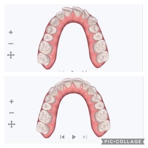 Got Access To My Clincheck Today R Invisalign