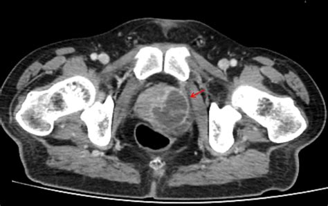 Systemic Spread Disseminated Abscesses In A Patient With Klebsiella