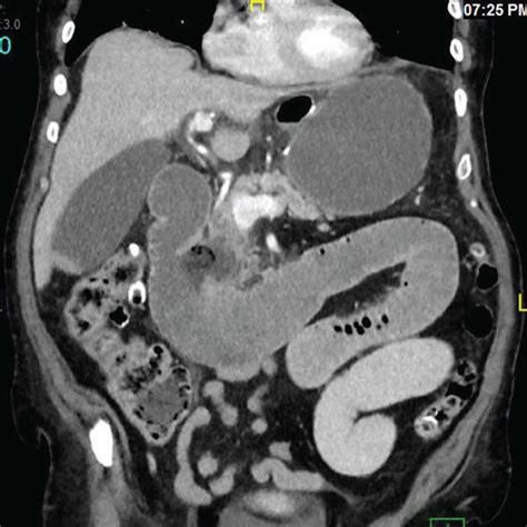 Ct Scan Of The Abdomen Showing A Duodenal Diverticulum With Dilation Of