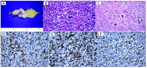 An Infiltrative Mass With Mucosal Irregularity Was Observed In The