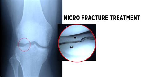 Micro Fracture Treatment Micro Bone Fracture Surgery