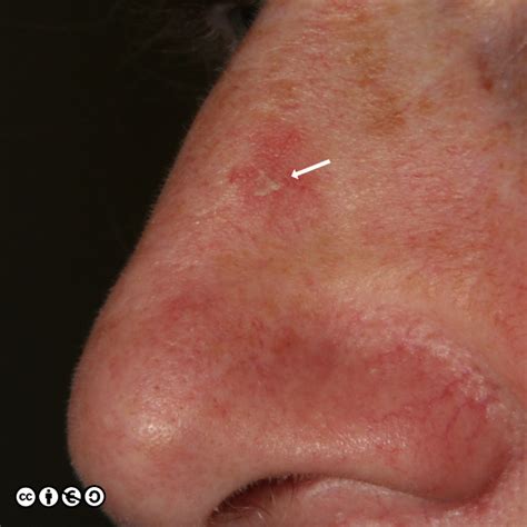Premalignant Lesions Skin Cancer 909