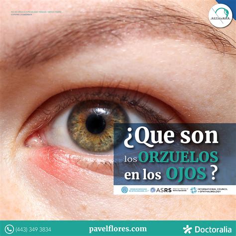 ¿que Son Los Orzuelos En Los Ojosmedia
