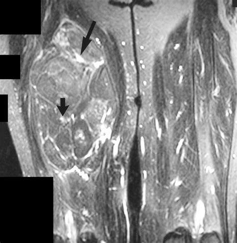 Lipomas Lipoma Variants And Well Differentiated Liposarcomas