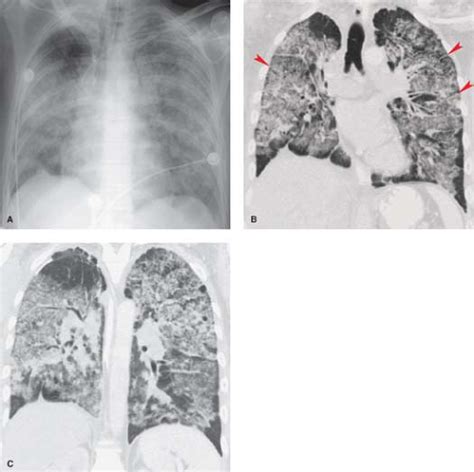 Diffuse Lung Disease Radiology Key