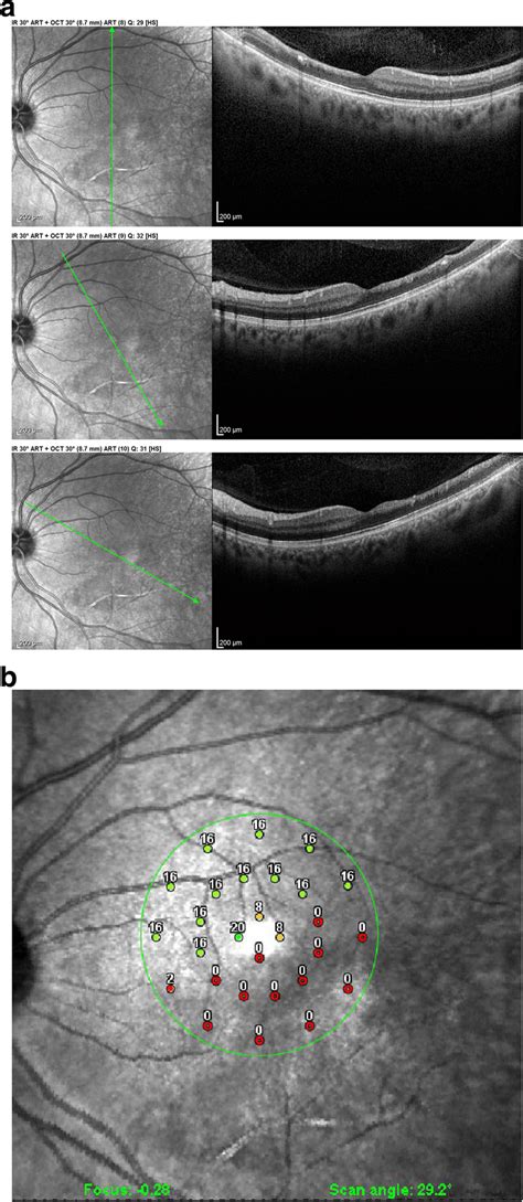 A Oct Imaging Of The Retina In A Patient 4 Months After Retinal Infarct Download Scientific