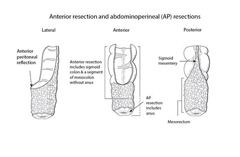 Peritoneal Reflection Of The Line