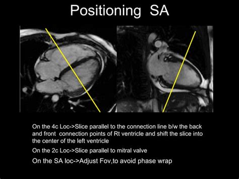 Cardiac Mri Slice Anatomy PPT Heart And Cardiovascular Diseases Diseases And Conditions