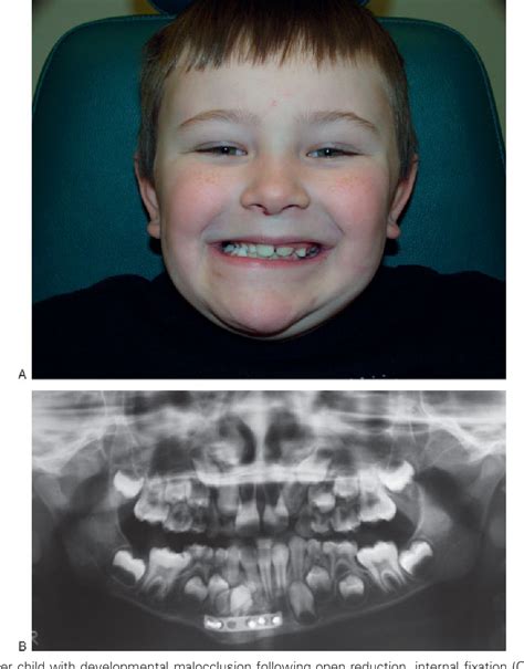 Figure 1 From Complications In Pediatric Facial Fractures Semantic