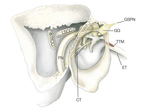 Retrosigmoid Approach The Neurosurgical Atlas By Aaron Cohen Gadol M D