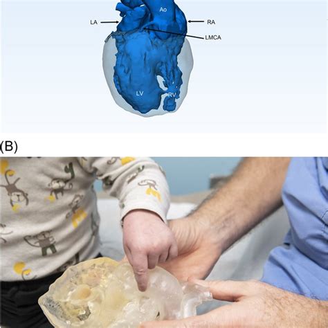 A Case 4 Virtual Model Derived From Cardiac Computed Tomography