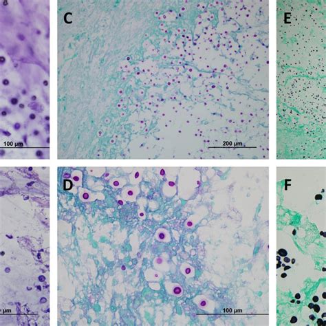 Cryptococcal Organisms Can Be Visualized Within The Brain Parenchyma Of Download Scientific