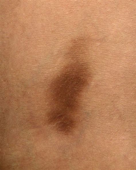 Itchy Rash From Fluconazole At Jesse Lombard Blog