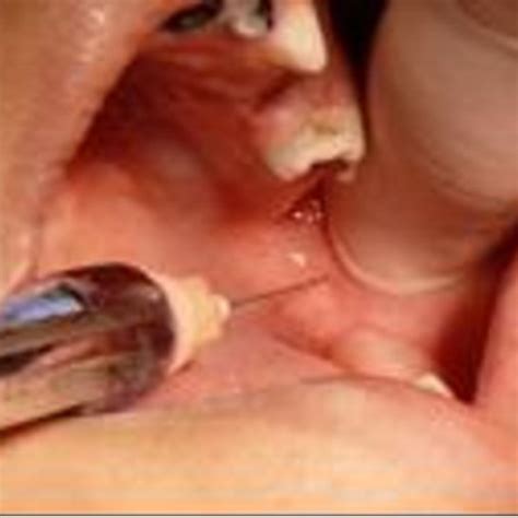 Pterygomandibular Triangle The Visible Lower Tip Was Considered As The