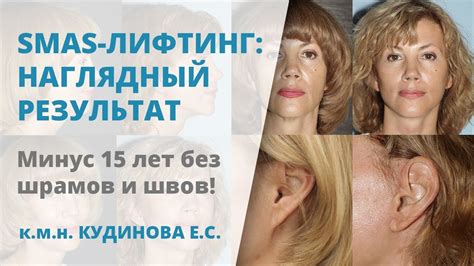 СМАС лифтинг лица – потрясающий результат без швов и рубцов - YouTube