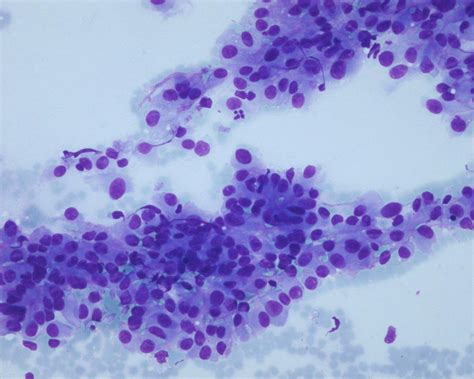Epithelioid Sarcoma Eurocytology