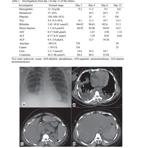 A Chest Radiograph Showing Bilateral Interstitial Infiltrates And