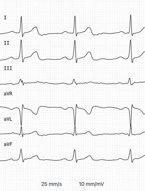 Why Are These Pvcs Look Different Are They Multifocal Or Its Just The Reading Different R