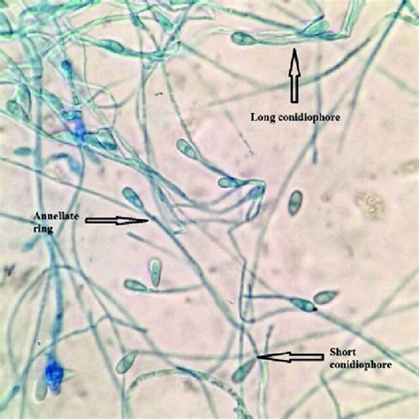 Lactophenol Cotton Blue Staining Showing Hyaline And Septate Hyphae