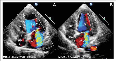 Figure 2 From Combined Pharmacological And Complex And High Risk Coronary Intervention Of