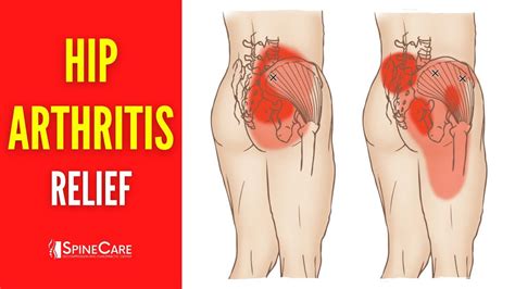 How To Relieve Hip Arthritis Pain In 30 Seconds Artofit