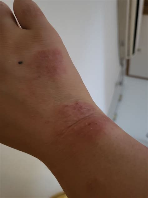 손에 물집 간지러움 피부 지식in