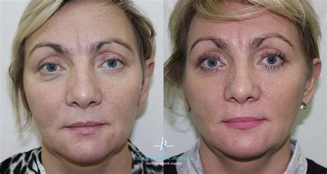 Подтяжка лица со СМАС пластический хирург Стрелин Святослав Москва