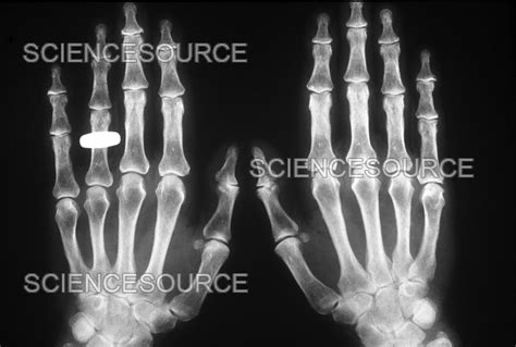 Osteoporotic Bone X Ray