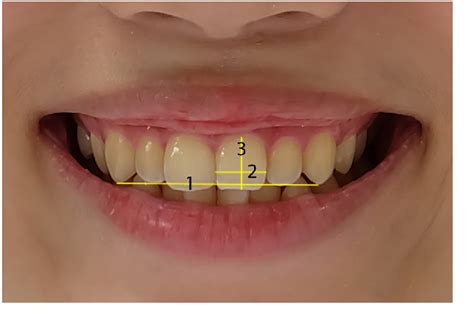 Table 1 From Two Dimensional Facial Measurements For Anterior Tooth