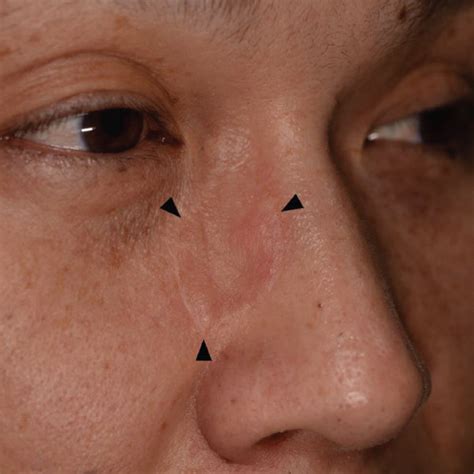 Design Of A Keystone Fasciocutaneous Advancement Flap Download