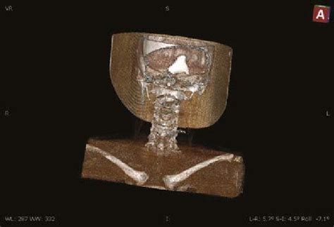 Computed Tomography In The Frontal Plane With Three Dimensional Download Scientific Diagram