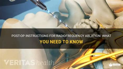 Post Op Instructions For Radiofrequency Ablation What You Need To Know