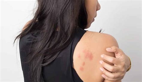 Black Mold Skin Rash