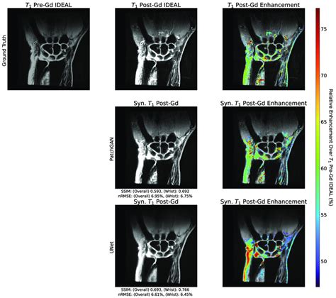 Predicted Gadolinium Enhancement Maps With Patchgan Unet And Ground