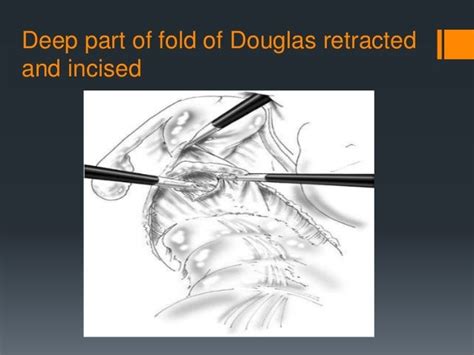 Rectal Prolapse