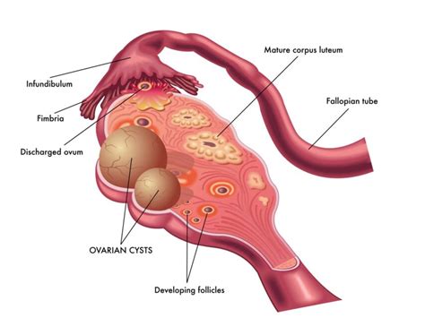 Ovulatory Disorder Causes Symptoms Infertility And Treatment Plan B Wellness