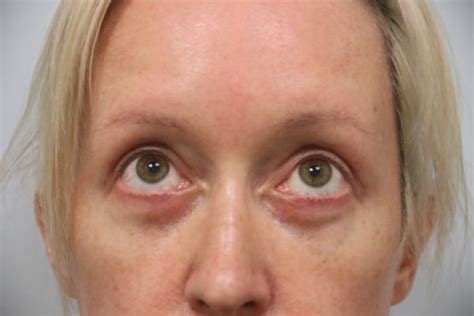 Blepharoplasty Case 2171 Dr Guy