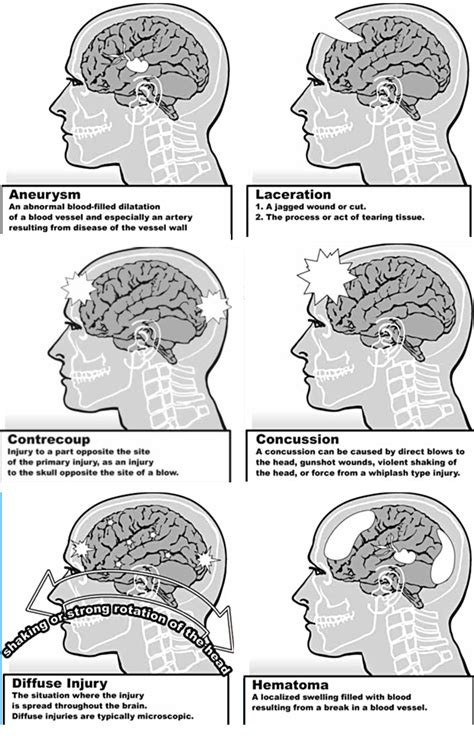 Traumatic Brain Injury Artofit