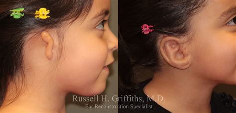 Case 4 One Stage Microtia Reconstruction Medpor Before And After