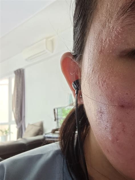 Sudden Bumps On My Left Cheek What Do I Do Racne