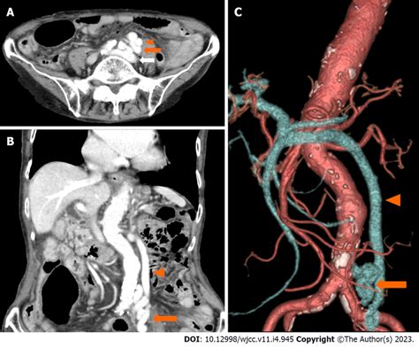 Abdominal Computed Tomography Scan With Contrast Enhancement A C
