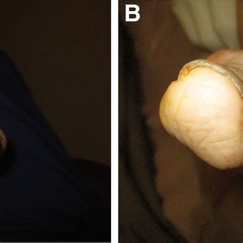 Correction Of Crossover Toe Deformity Of Left Second Toe By Plantar