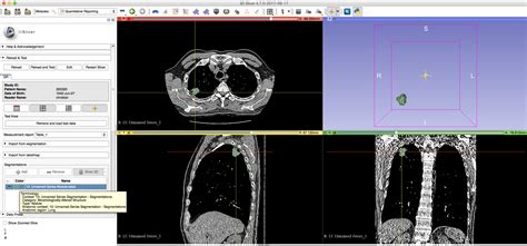 Anatomic Region Modifier Is Not Displayed In Terminology Tooltip