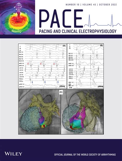 Efficacy Of Ablation Index‐guided Pulmonary Vein Isolation In Patients With Paroxysmal Atrial