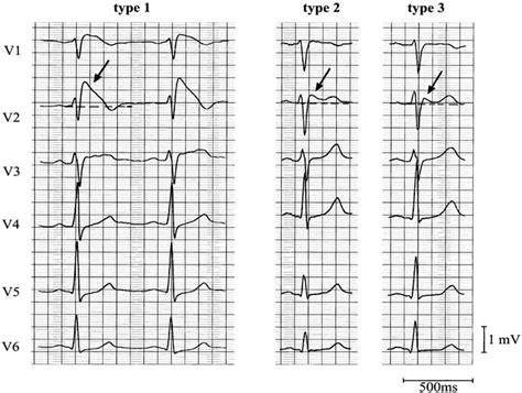 Brugada Syndrome • Litfl • Ecg Library Diagnosis