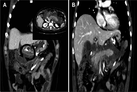 CT Showing The Concept Of Multitransgastric Necrosectomy A Download Scientific Diagram