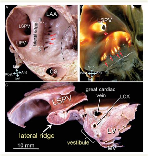 Figure 2 From The Role Of Myocardial Wall Thickness In Atrial Arrhythmogenesis Semantic Scholar