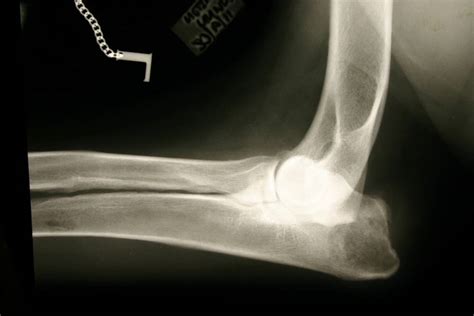 Case Report Olecranon Osteosarcoma In A Great Dane Downs Veterinary Referrals