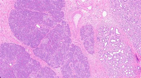 Pathology Outlines Heterotopic Pancreas